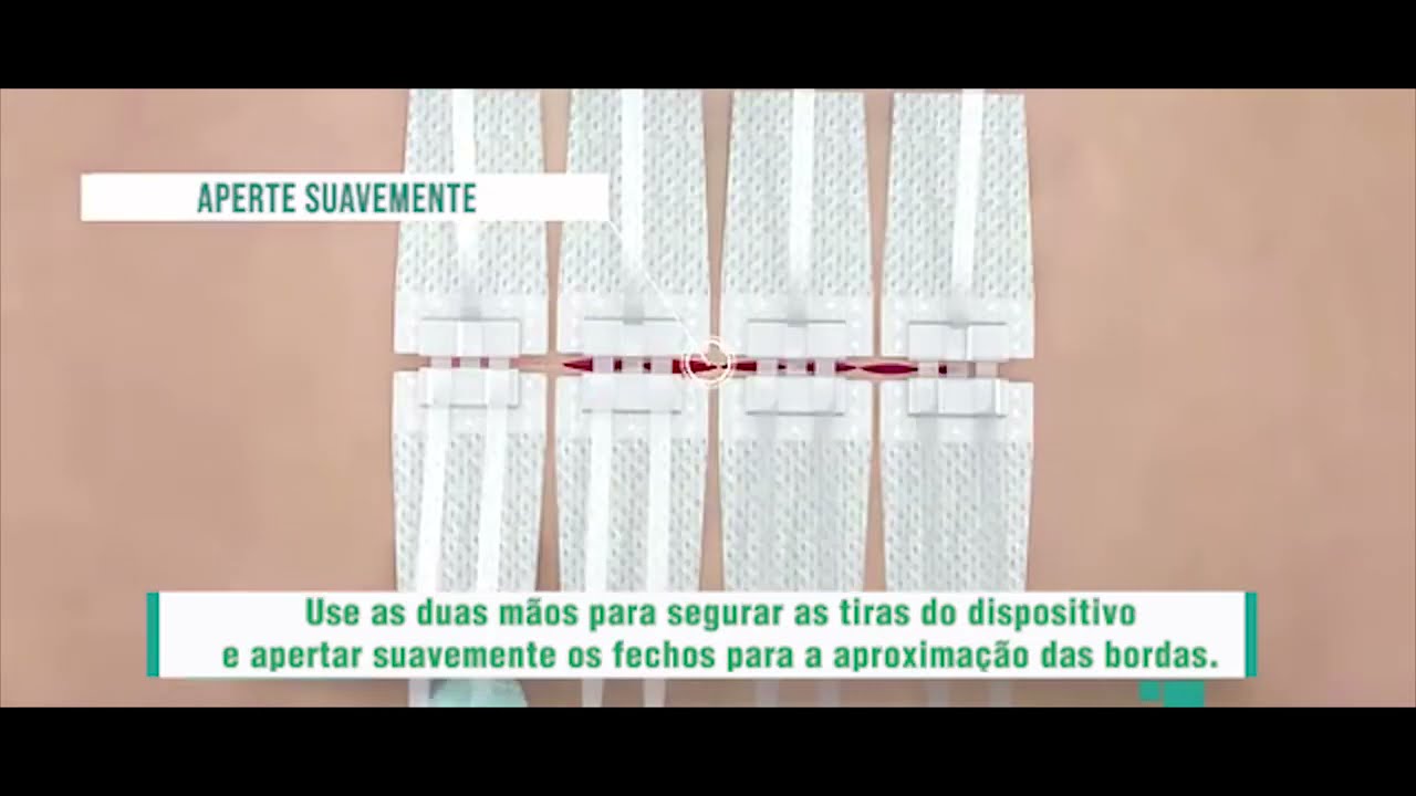 Curativo MEM Cirúrgica Skin Closure Ponto Falso para Fechamento de ...