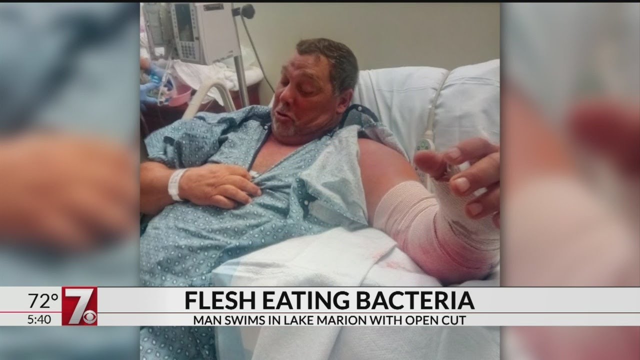 Man gets flesh eating bacteria after swimming in SC lake - YouTube