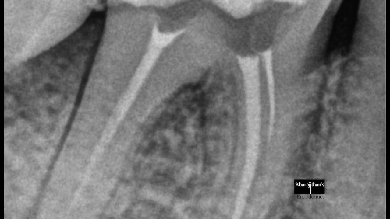 INSTRUMENT RETRIEVAL DEMONSTRATION USING ULTRASONICS & BTR PEN - YouTube