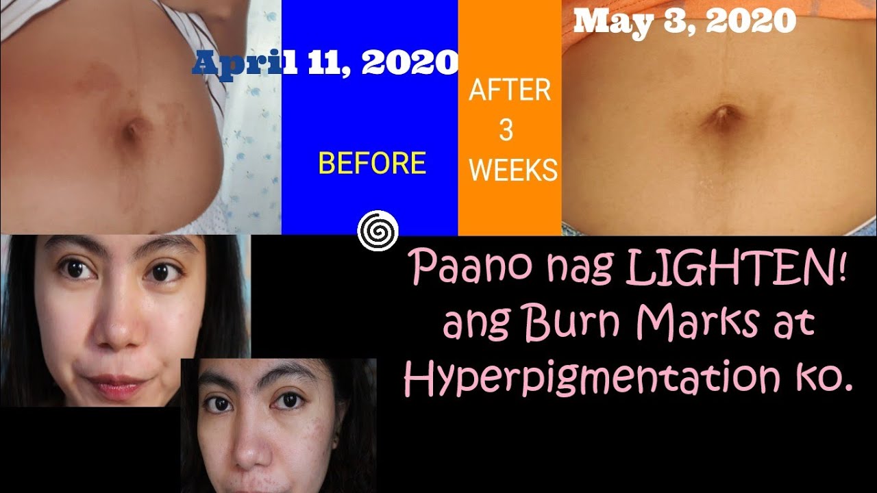 Paano ng LIGHTEN ang Burn Marks at Hyperpigmentation ko| Correcting ...
