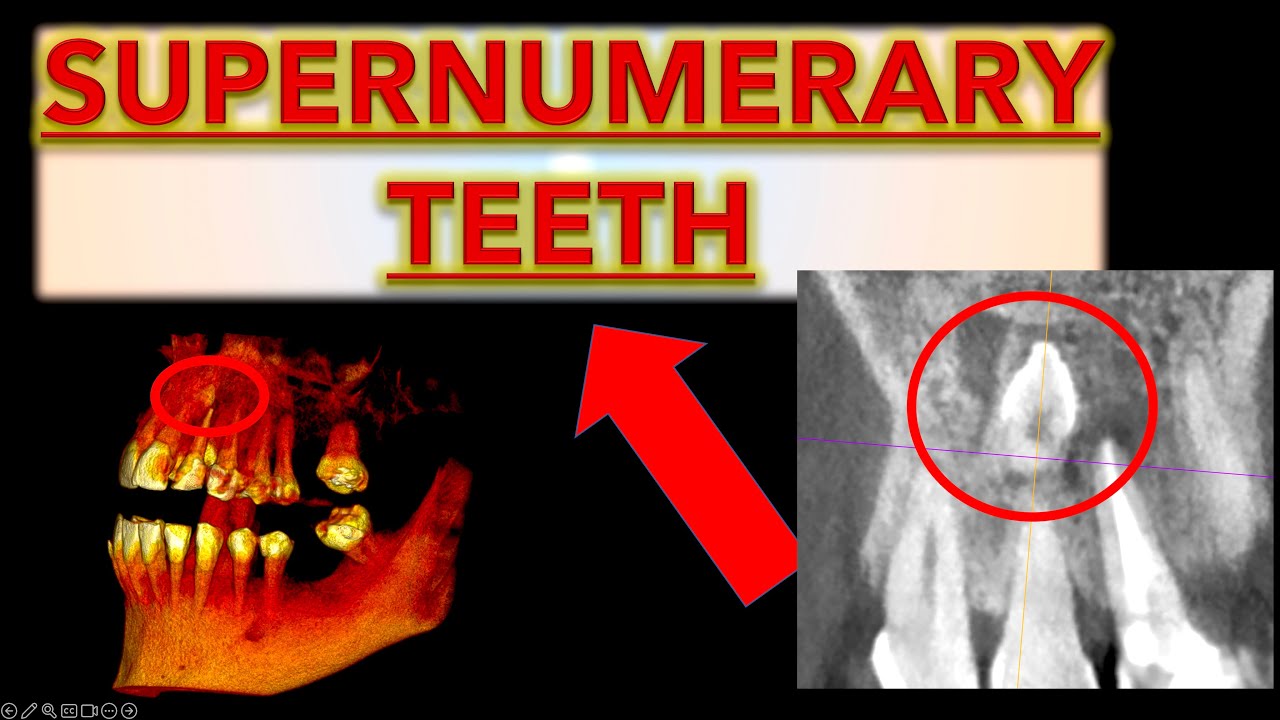 How To Make Sure It Is A Supernumerary Tooth Extra Teeth In Mouth