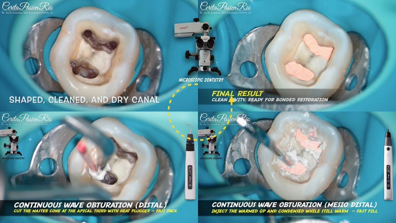 4 warm vertical compaction bioceramic ceraseal molar endodontic fast ...