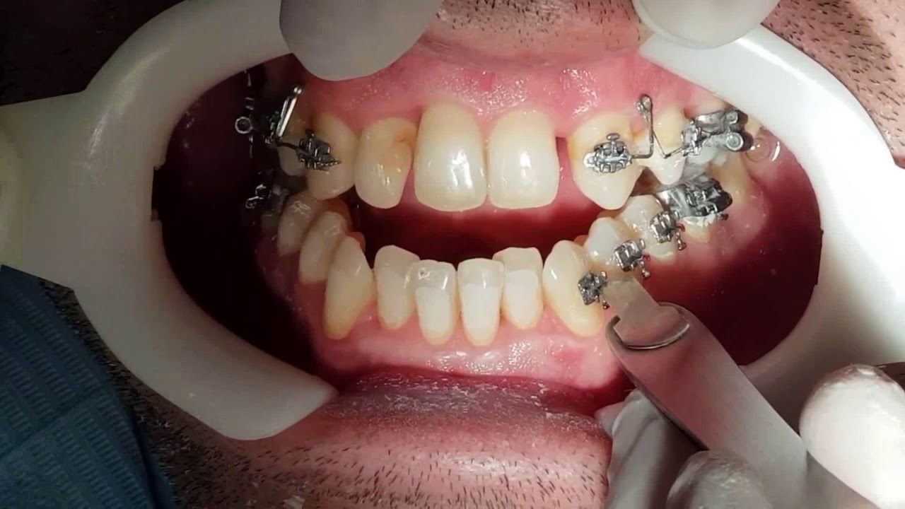 ADHESION BRACKETS DR GALLARDO CLINICAORTODONCIAJAEN - YouTube