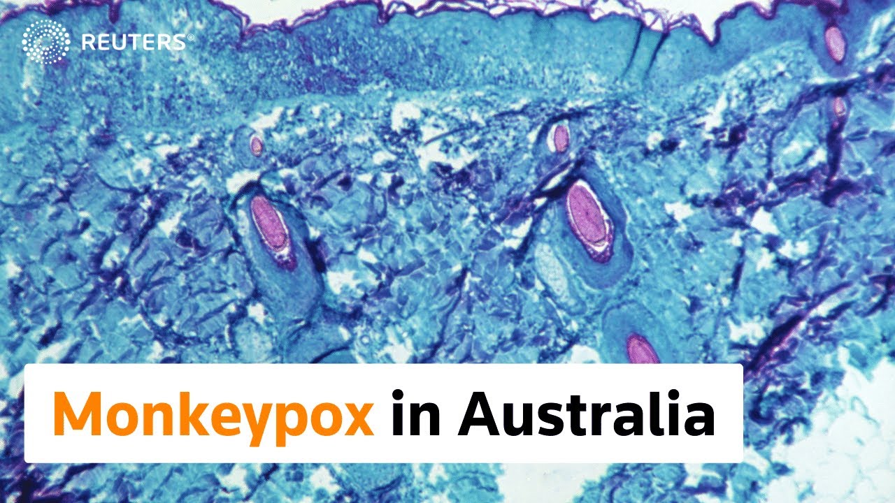 Australia reports first confirmed case of monkeypox - YouTube