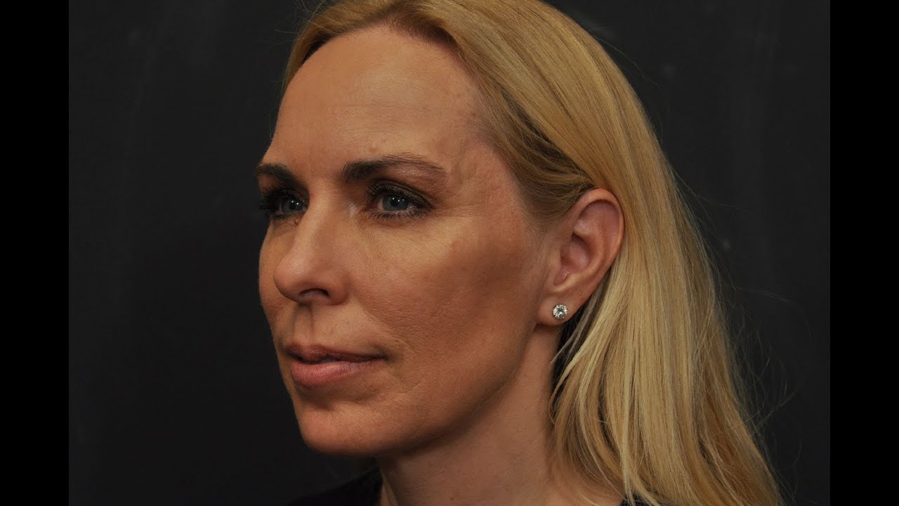 Juvederm Voluma Cheek Filler Demo by Dr. Craig Jonov, The Gallery of ...