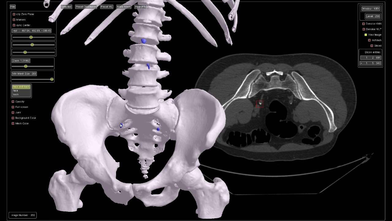 3D Spine (www.vi3dim.com) - YouTube