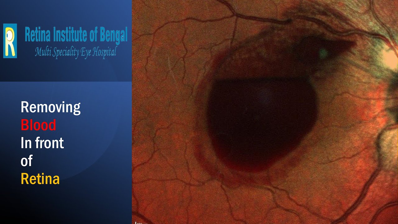 Removing Blood in front of the Retina - YouTube
