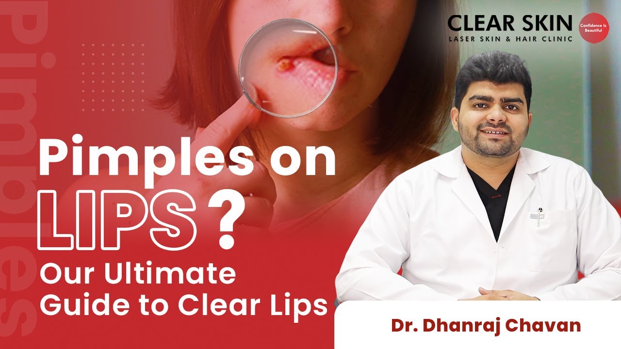 Pimples On Lips How To Get Rid Of Pimples On Lips Ultimate Guide To pimples-on-lips-how-to-get-rid-of-pimples-on-lips-ultimate-guide-to