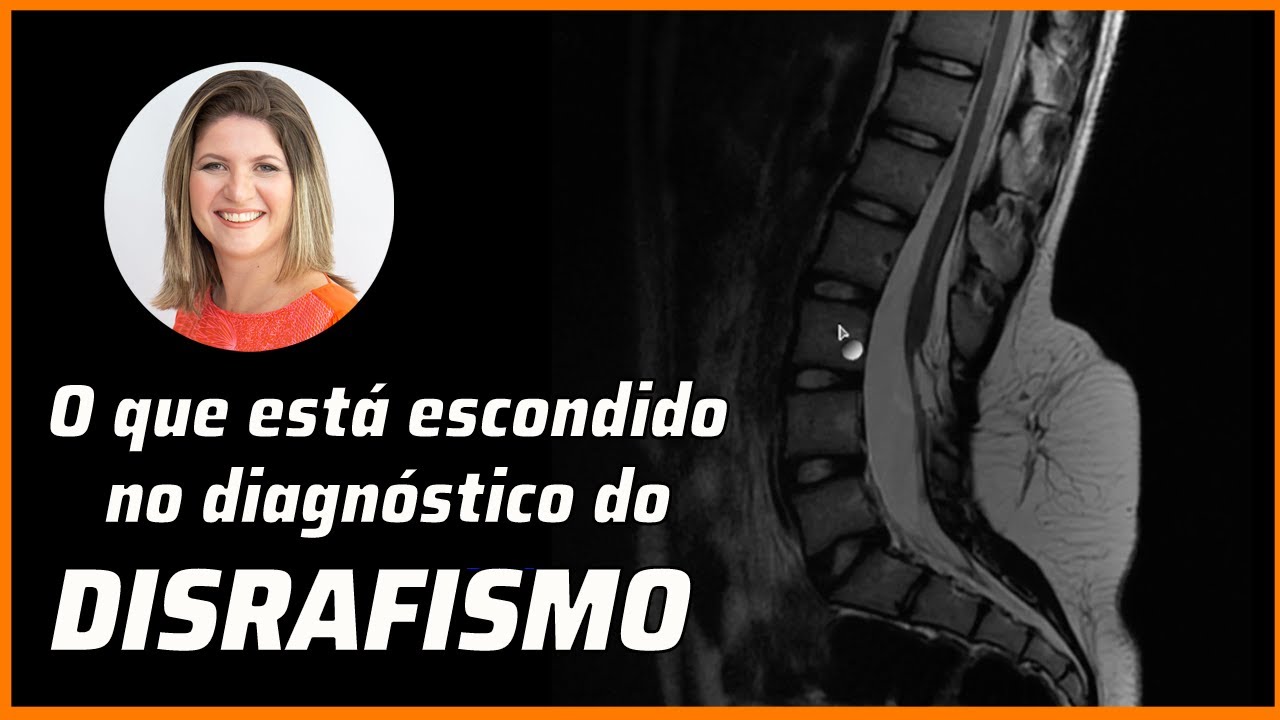 DIAGNÓSTICO DO DISRAFISMO: AS MALFORMAÇÕES DA COLUNA VERTEBRAL - YouTube