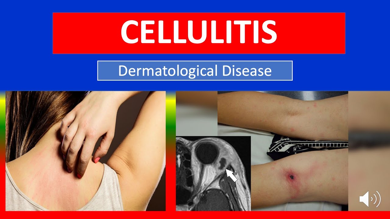 CELLULITIS - Definition, types, cusses, pathophysiology, signs ...