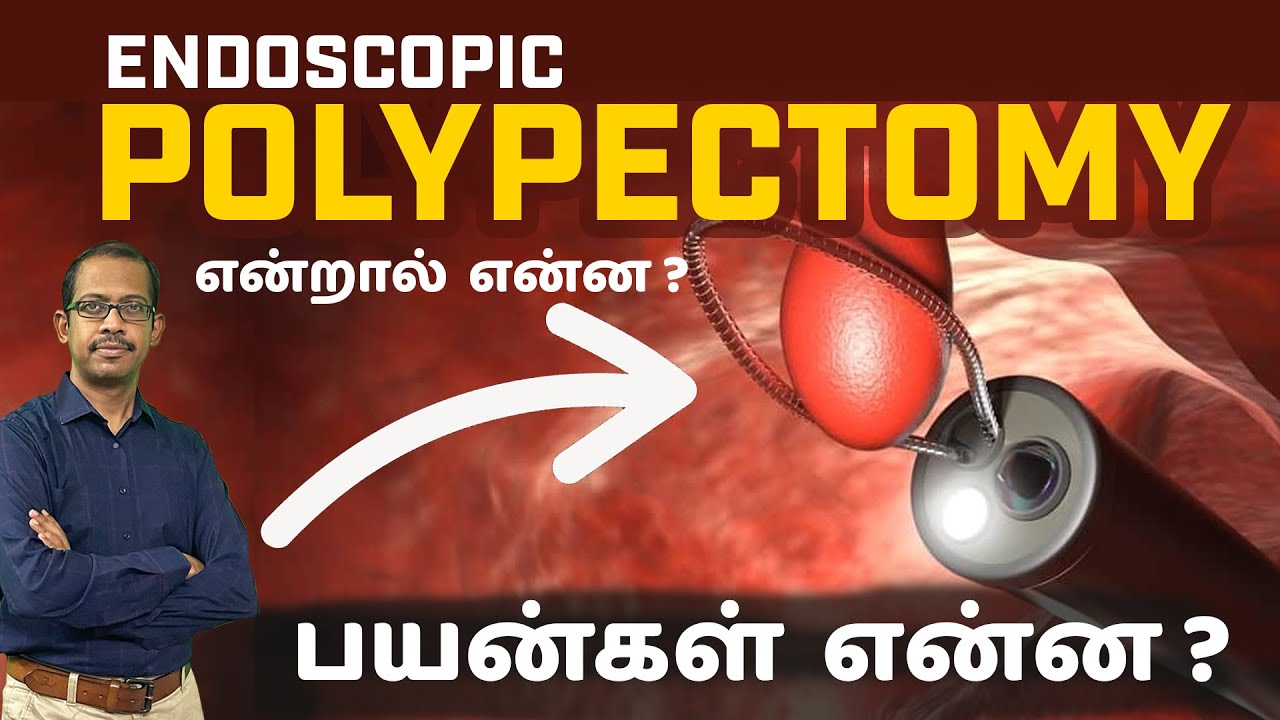 What is Endoscopic Polypectomy? 🧐 What are the benefits of a ...