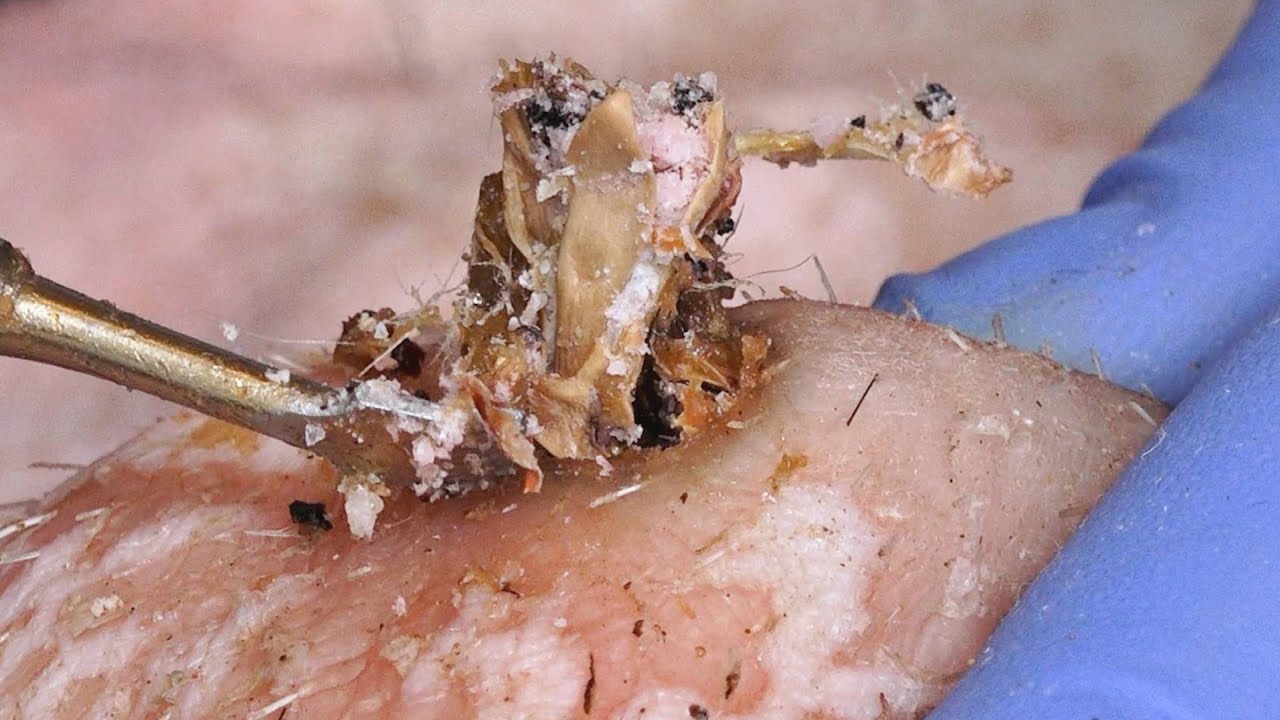 Dr. Lee Geoff Butler Enilsa MrPopZit 🌝 Professional pedicure process 🌝 ...