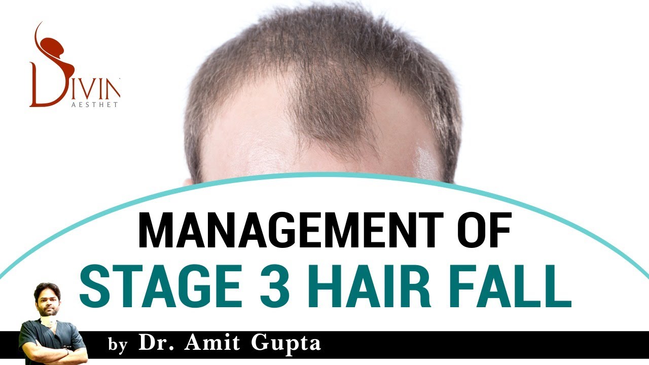 Management of Stage 3 Hair Fall Cost and Technique | Dr. Amit at Divine ...