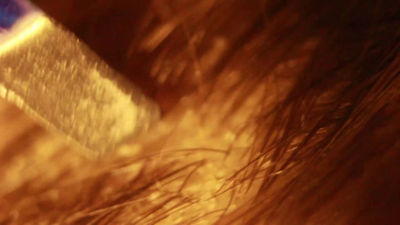 Disgustingly Satisfying Dandruff Scalp Scratching - YouTube