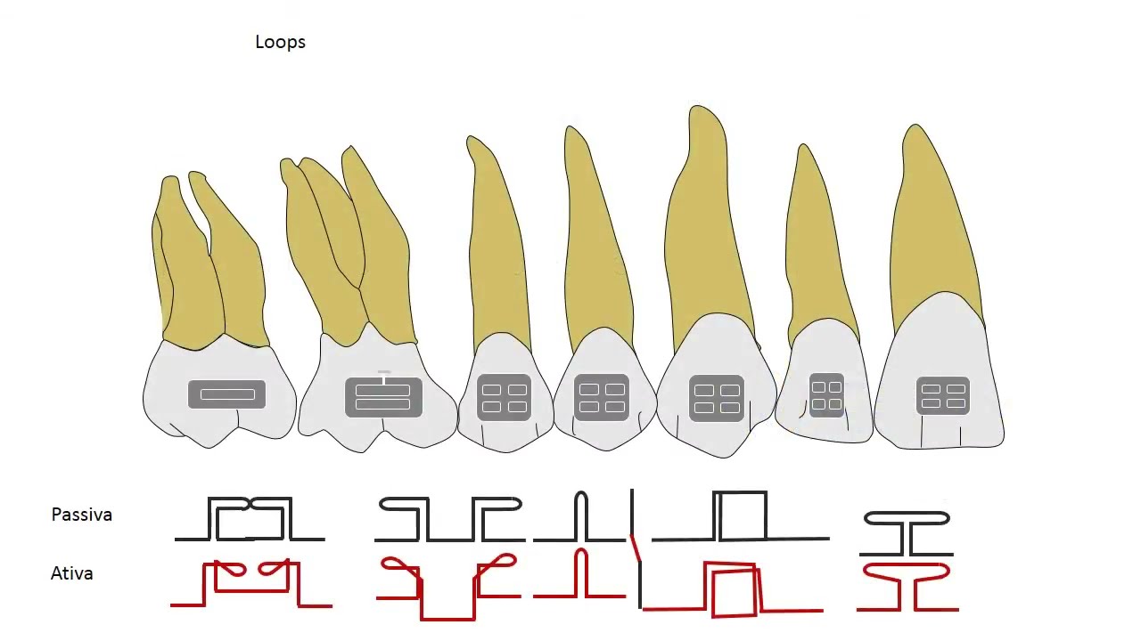 Orthodontic Order Bends at Tiffany Bone blog