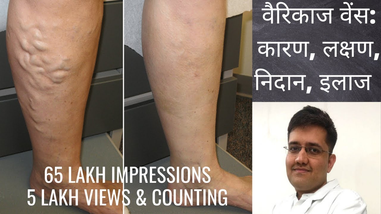 Varicose Veins Treatment Varicose Veins In Hindi Dr Gaurav