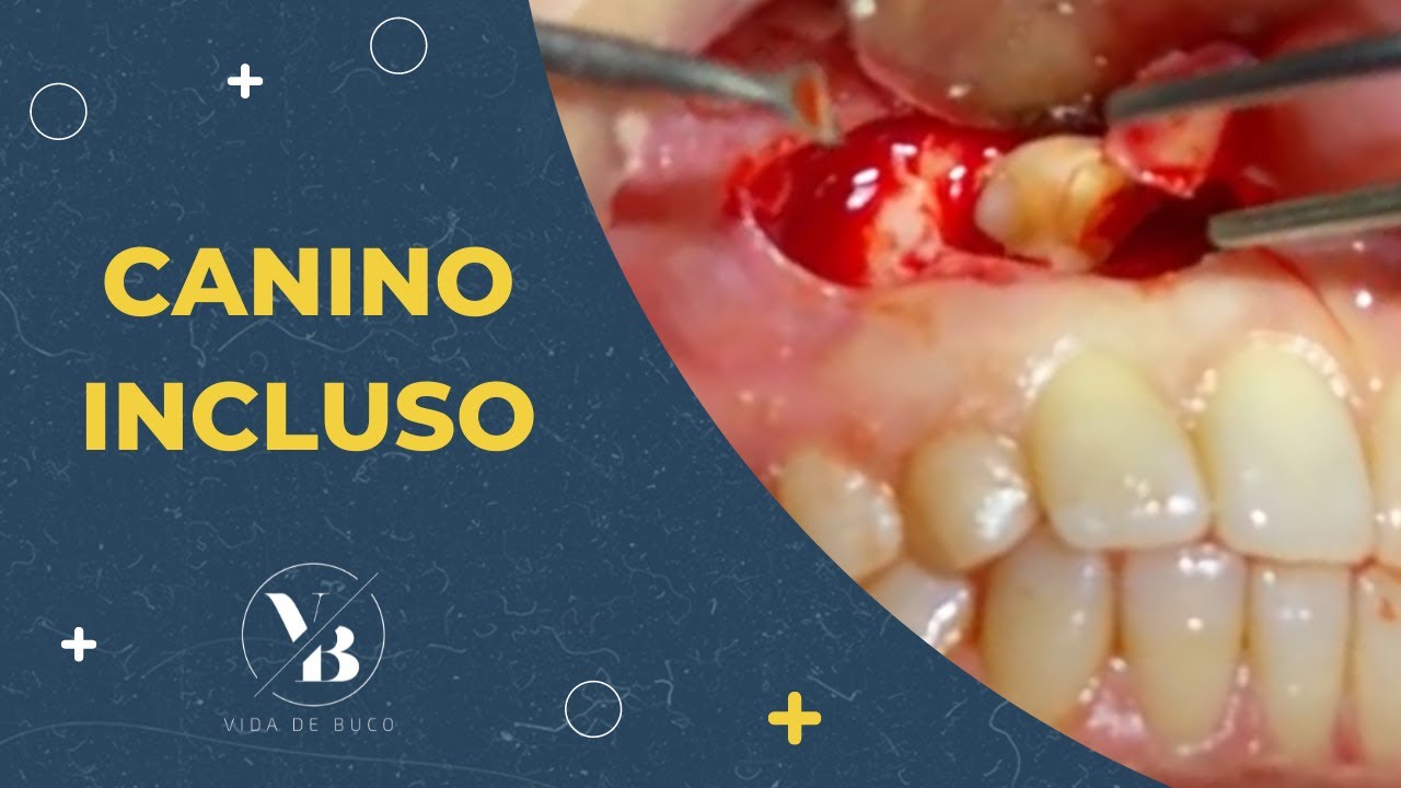 🦷 EXTRAÇÃO DE DENTE CANINO INCLUSO - YouTube