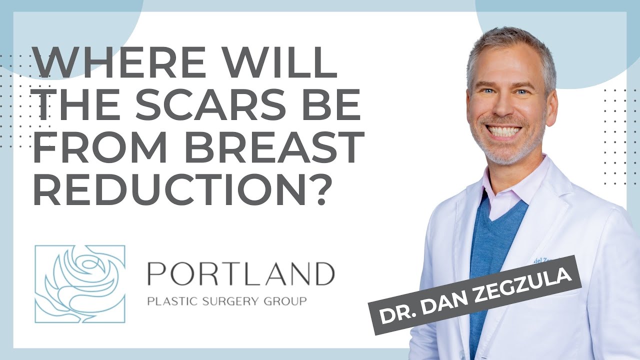 Where will the scars be from breast reduction? - YouTube