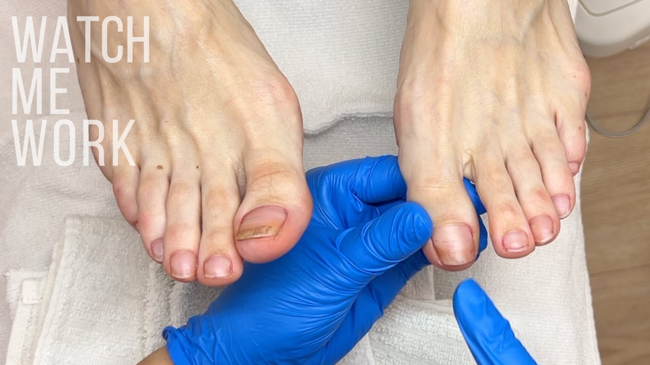 Pedicuring toenails with micro trauma [follow up] - YouTube