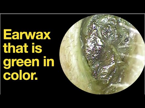 Earwax that is green in color. |ear wax removal | ear cleaning | ASMR ...