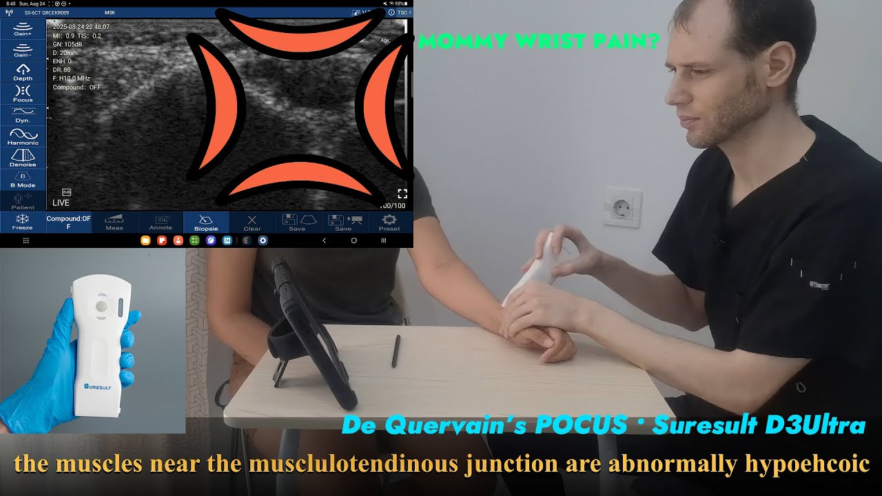 POCUS for De Quervain’s Tenosynovitis | Mommy Wrist Scan with Suresult ...