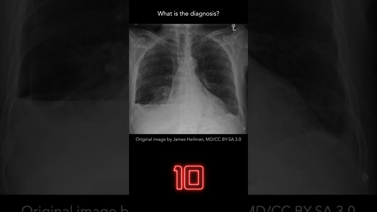 Chest X-ray Question 13 - YouTube