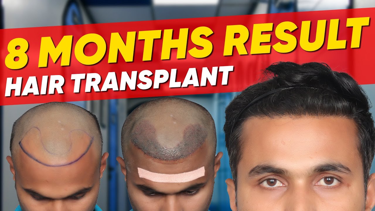 Hair Transplant in Toronto | Best Results & Cost of Hair Transplant in ...