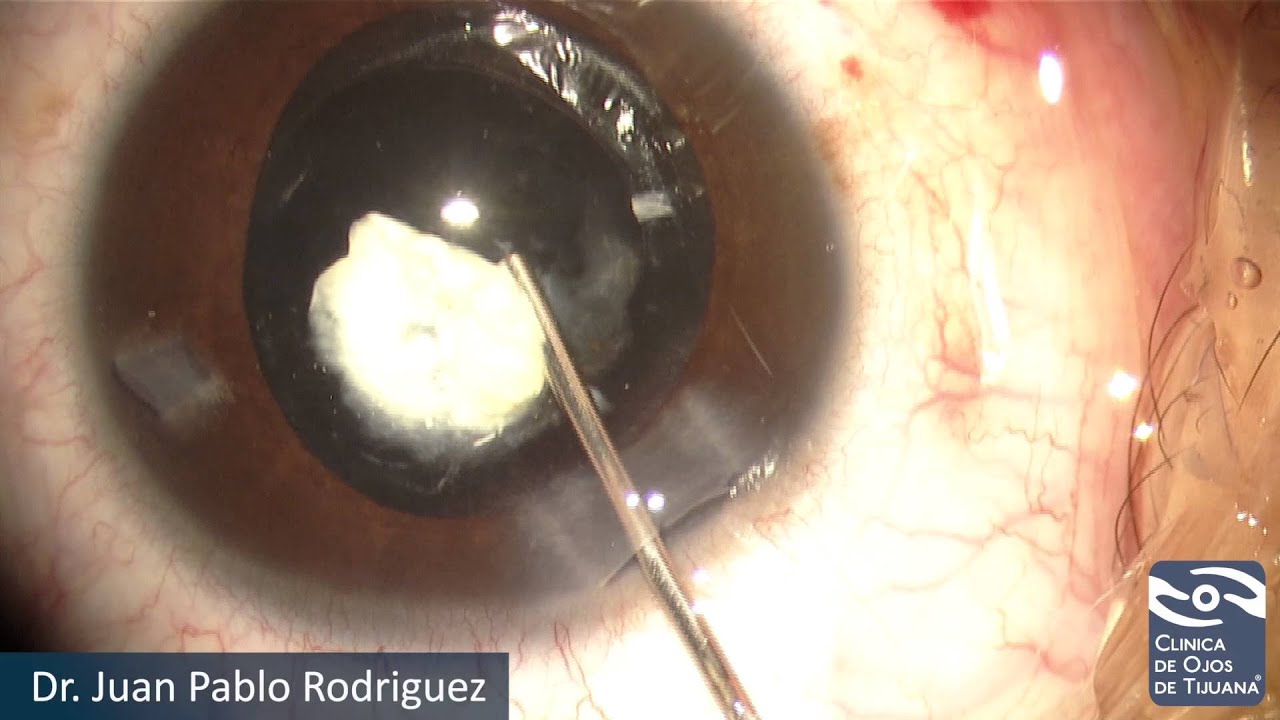 Catarata Polar Congenita - YouTube