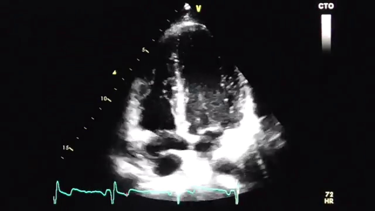 Darstellung des Koronarvenensinus (Sinus coronarius) / (Representation ...