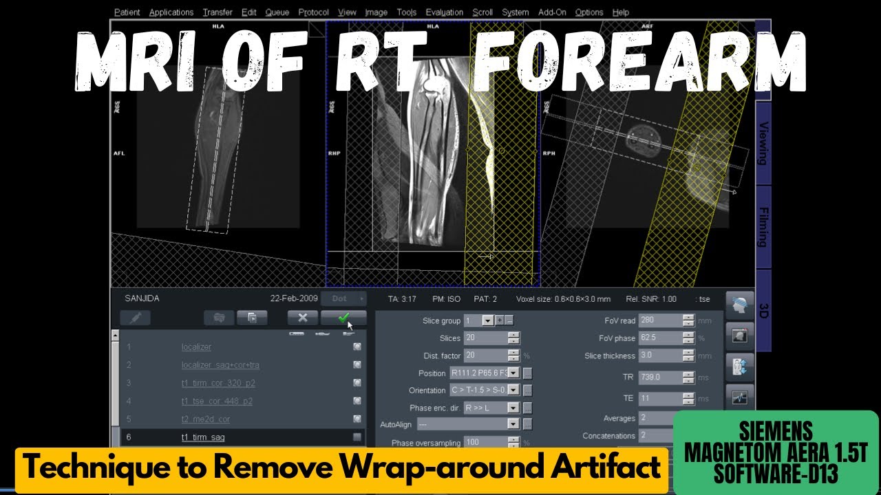 MRI of Right Forearm Technique - Live Console Tutorial | Large Flexible ...