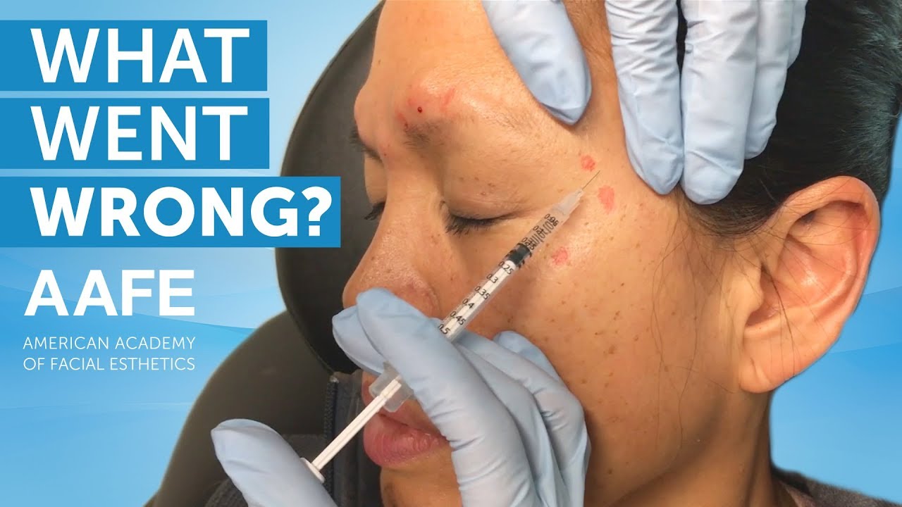Corrective Botox Treatment For Arlene Aafe Youtube