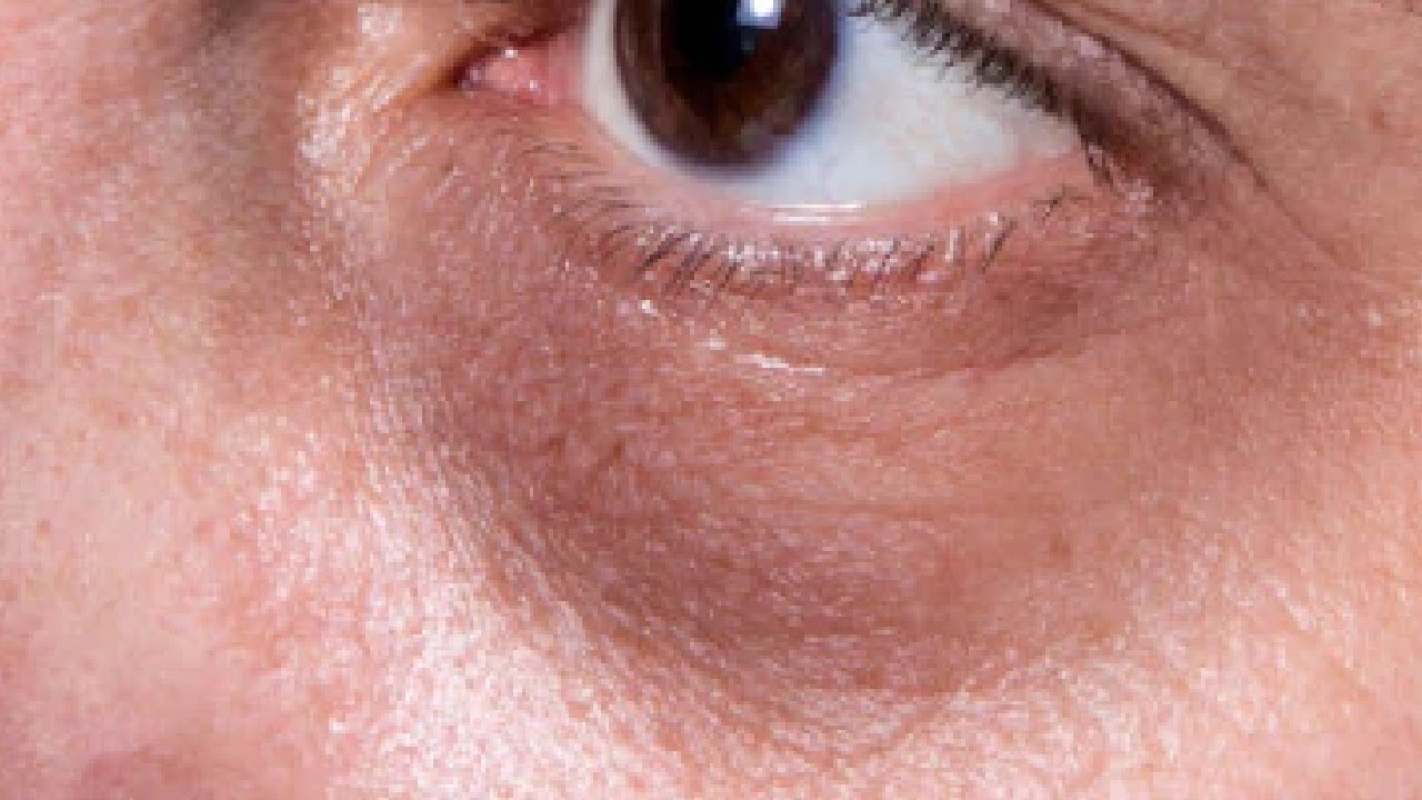 How To Get Rid Of Dark Circles Around Eyes Easy YouTube how-to-get-rid-of-dark-circles-around-eyes-easy-youtube