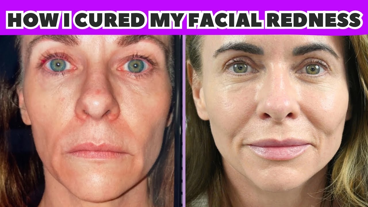 Why Your Face is Always Red & How To Fix It - YouTube