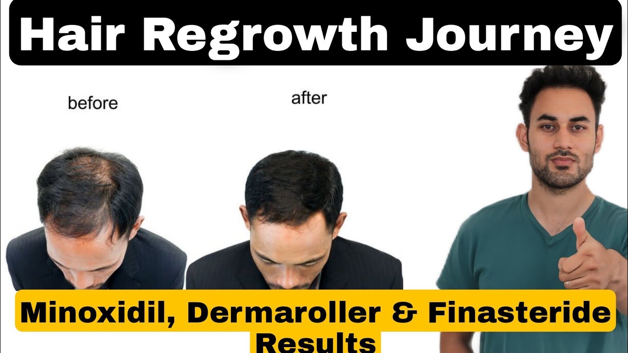 How you can achieve Hair Regrowth: Minoxidil, Dermaroller and ...