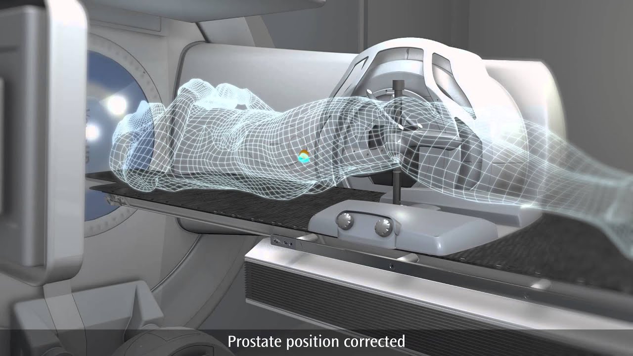 Elekta - Electron Boost VersaHD - YouTube