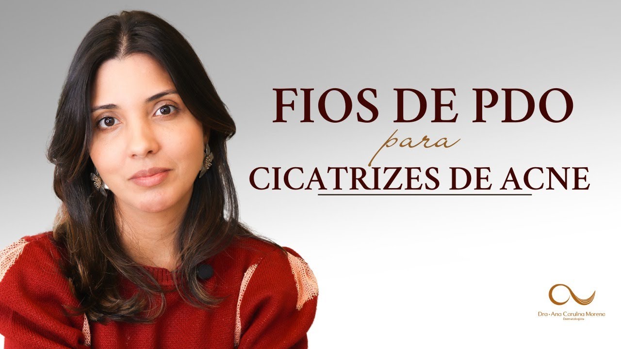 Fios de PDO para Cicatriz de Acne - YouTube