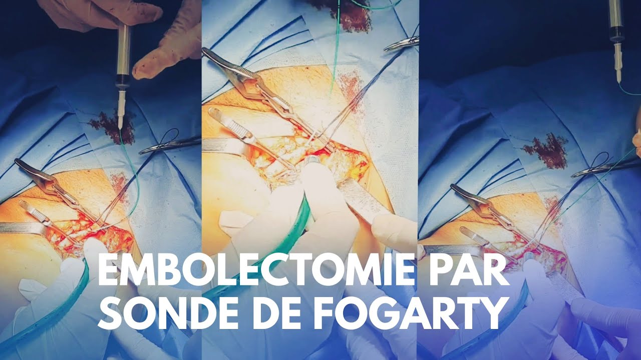 Embolectomie d'urgence : Fogartisation pour une ischémie artérielle ...