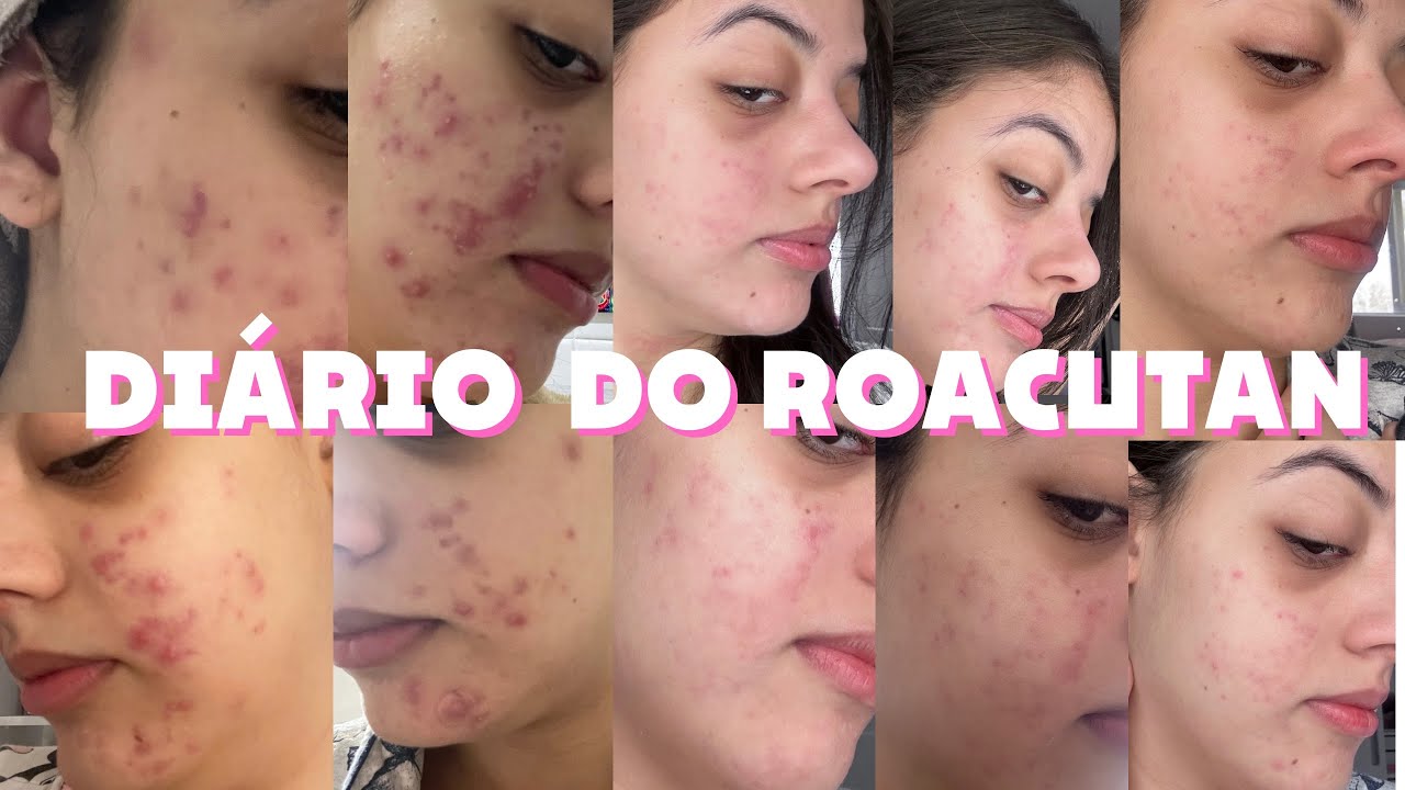 DIÁRIO DO ROACUTAN! Meu 2º e 3º mês! Sintomas, produtos e resultados ...