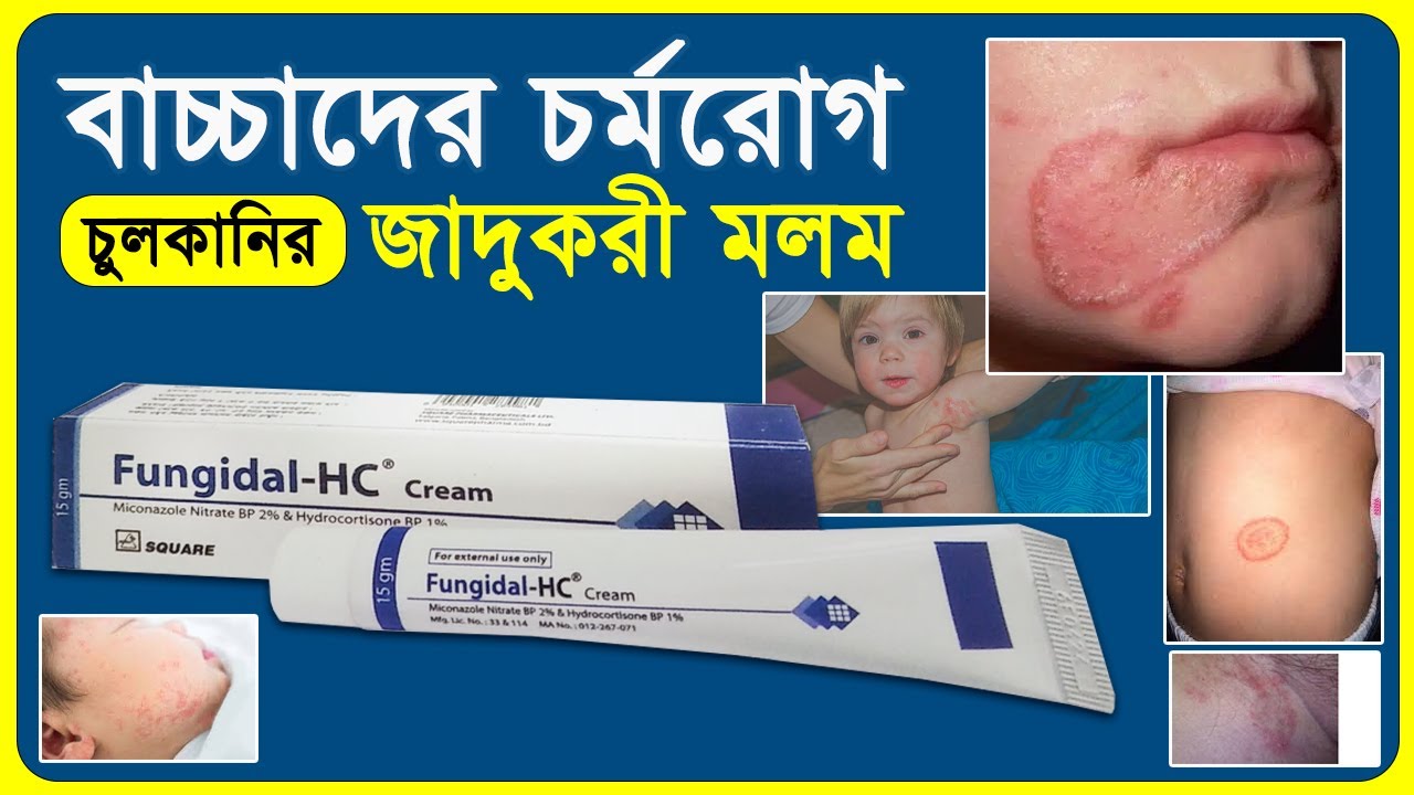 এক মলমে বাচ্চাদের চর্মরোগ হতে মুক্তি! 🌼 Using Fungidal HC Cream for ...