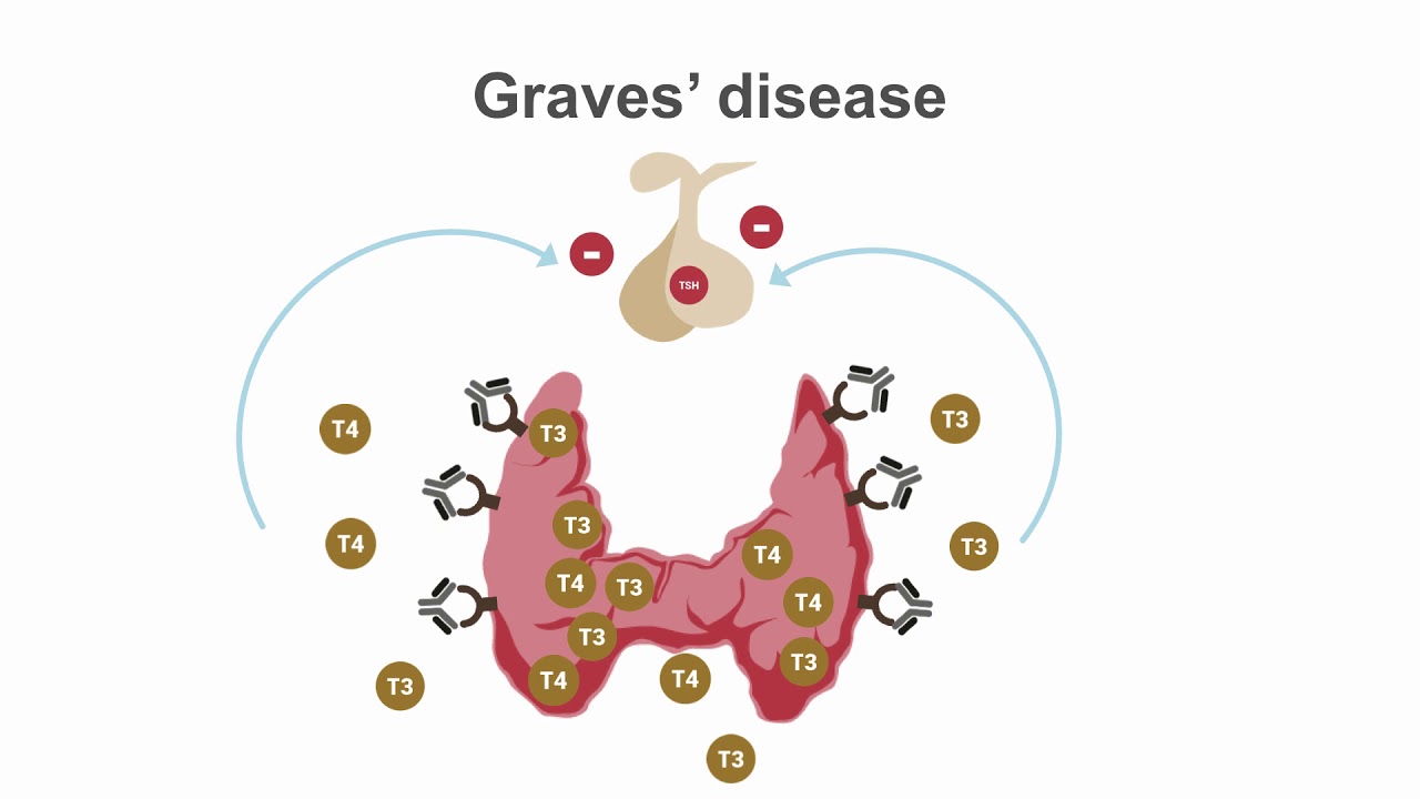 How to recognize subclinical hyperthyroidism. - YouTube