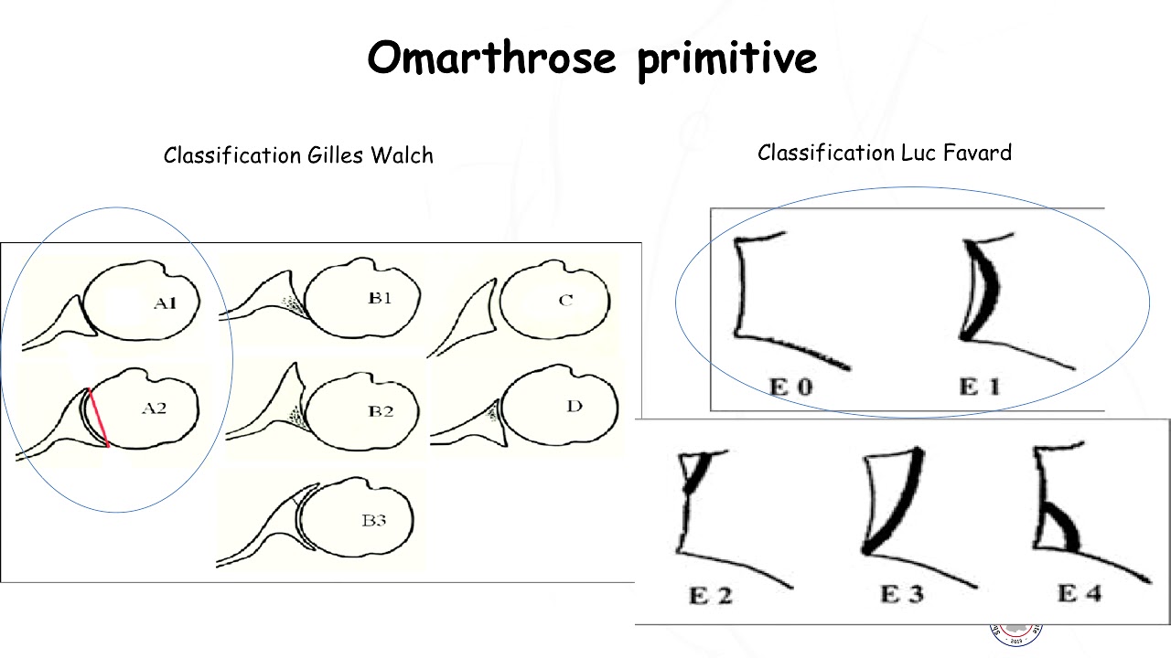 Prothèse d'épaule - YouTube