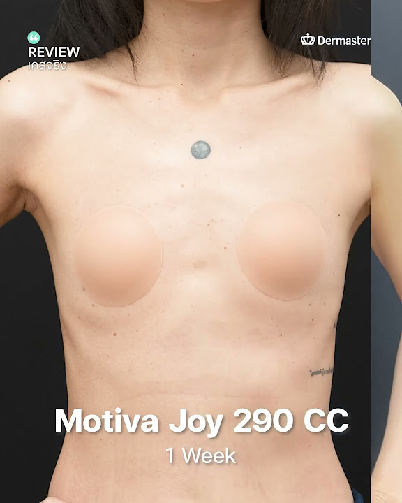 เสริมหน้าอก Motiva Joy 290 cc อกสวยสมตัว เนียนเหมือนมีมาตั้งแต่เกิด ️ - YouTube
