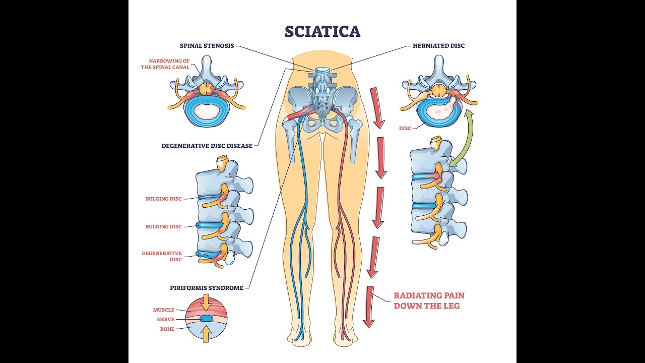 Ryggsmerter og spinal stenose - YouTube