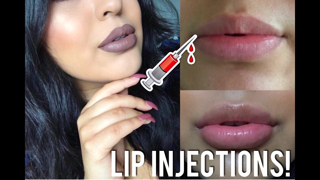 LIP INJECTIONS VLOG! My Honest Experience | Danielap526 - YouTube