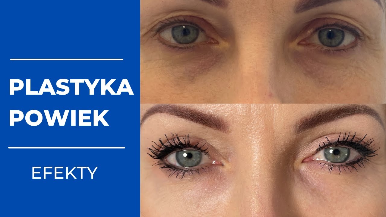 Plastyka powiek górnych przed i po. Opinie pacjenta. Blefaroplastyka ...