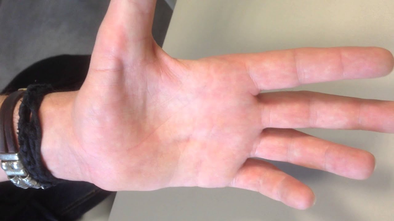 atrophie au niveau de la main sur compresion du nerf cubital au coude ...