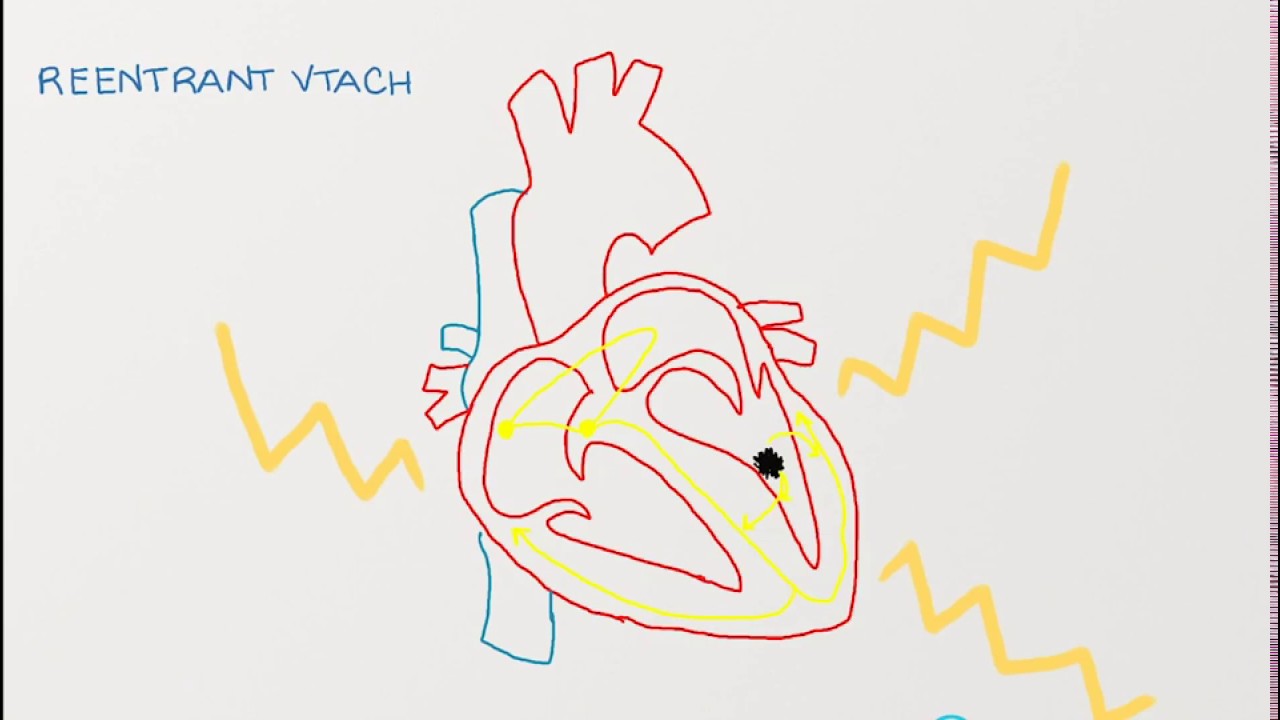 Ventricular Tachycardia - Types, Causes, and Treatment Approaches - YouTube