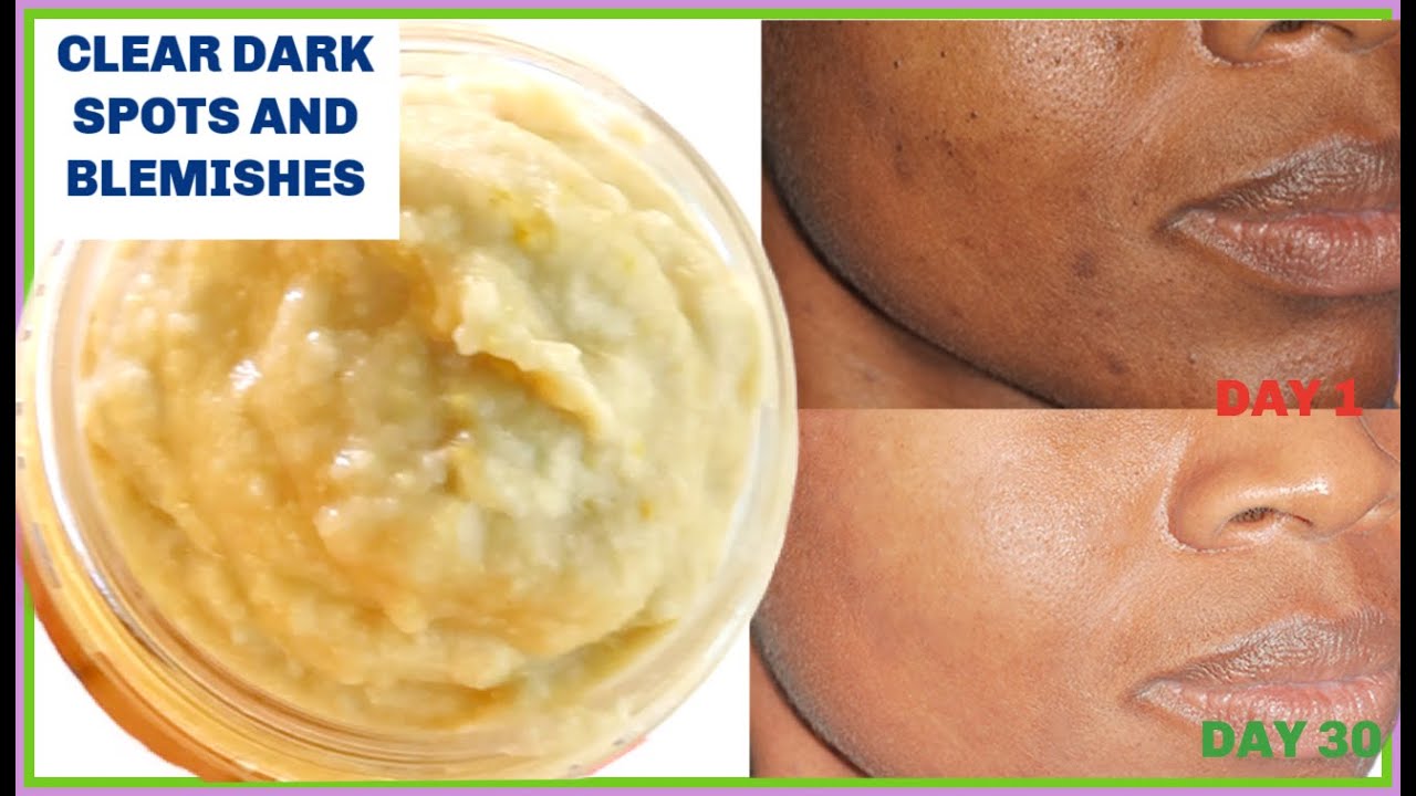 Say Goodbye to Dark Spots: Skin Transformation in 6 Weeks | Khichi ...
