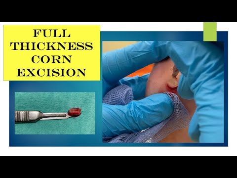 Video - full thickness corn excision (another case) - YouTube