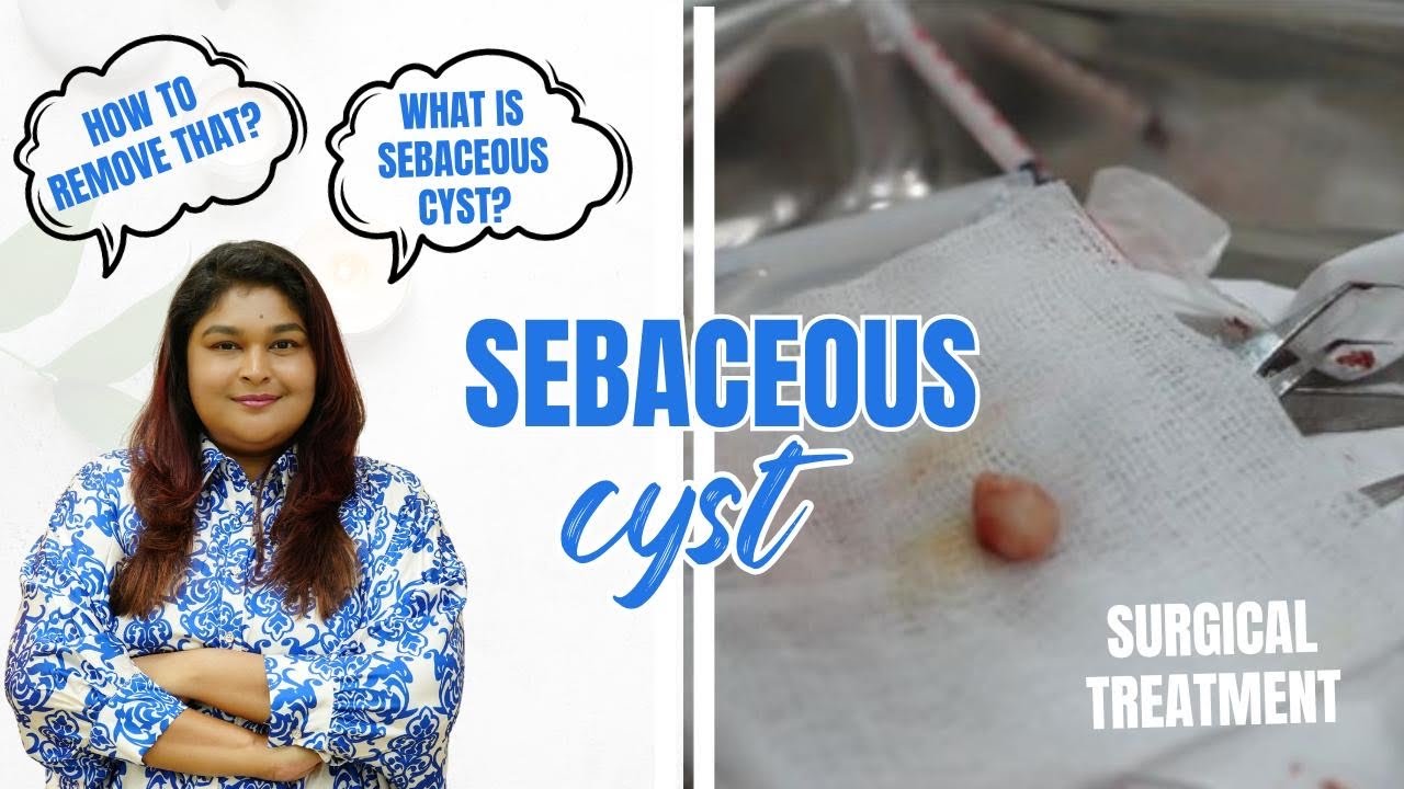 How To Remove Sebaceous Cyst Youtube